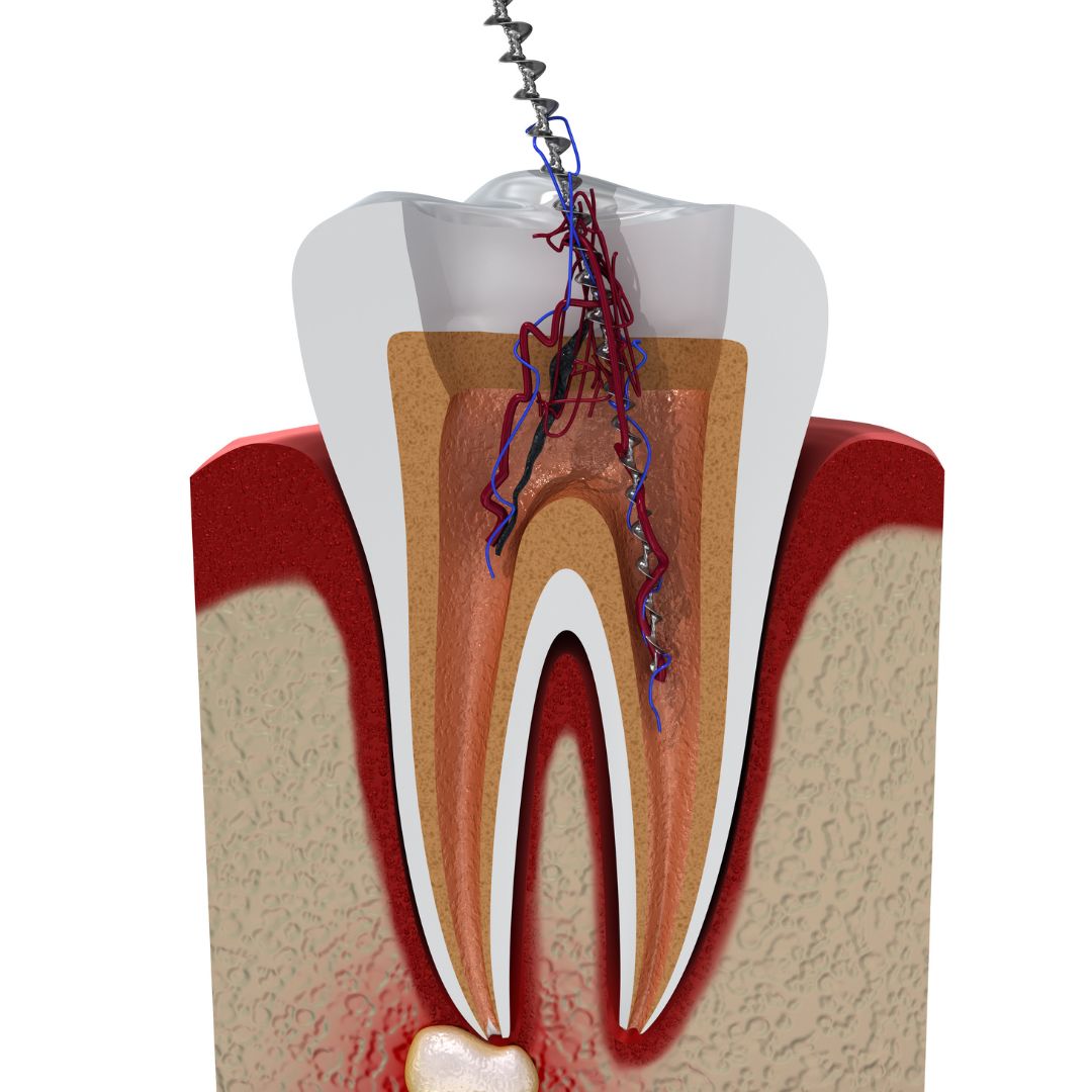 Understanding the Step-by-Step Root Canal Procedure - Aurora Smiles